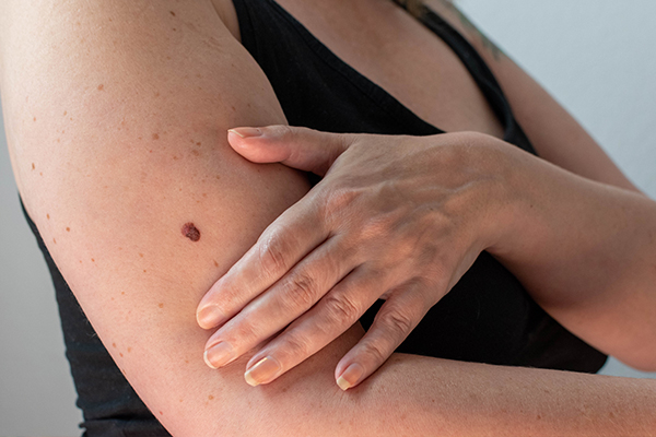 Spot the Signs: A Simple Guide to Skin Cancer Exams