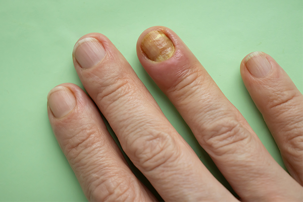 Nail Infections You Shouldn’t Ignore: Understanding Paronychia