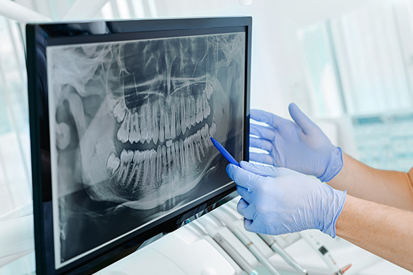 Comprehensive Oral Health: Why Dental Panoramic X-rays (OPG) Matter
